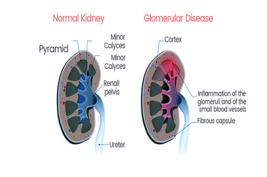 Glomercular Disease – Dr. Pinaki Mukhopadhyay